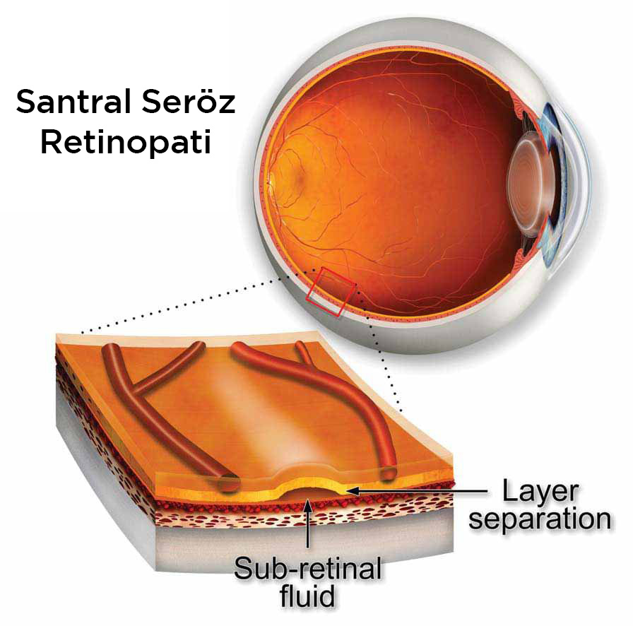 Santral Seröz Retinopati Nedir? Nasıl Tedavi Edilir? - Prof. Dr. Filiz ...